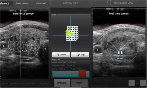 High Intensity Focused Ultrasound Hifu Ablation Of Benign Thyroid