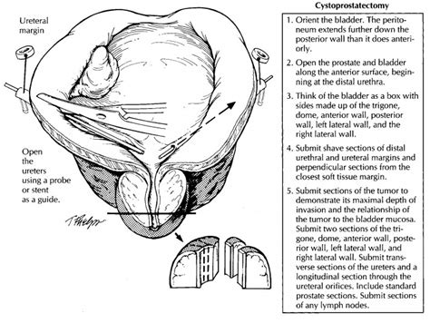 Bladder Surgical Pathology Dissection