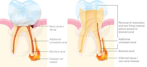 Root Canal Re Treatment
