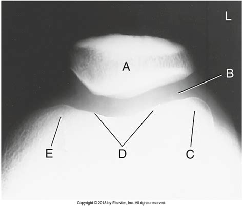 Xray Sunrise View Of Knee Diagram Quizlet