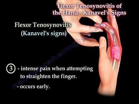 Flexor Tenosynovitis Of The Hand Kanavels Signs Youtube