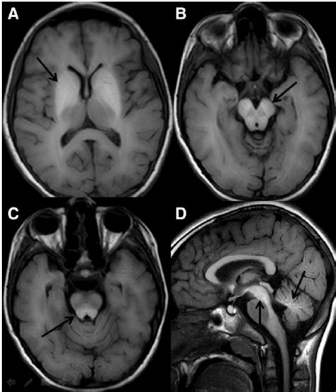 T1 Weighted Brain Mri Discloses Bilateral Hyperintense Signal In Basal Download Scientific
