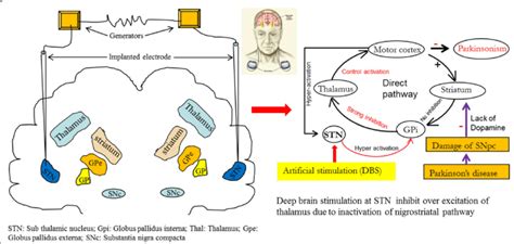 Schematic Diagram Show The Process Of DBS In DBS STN Or Thalamus Or Download Scientific