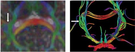 Directionally Encoded Color Maps Of Optic Radiation Via A Diffusion