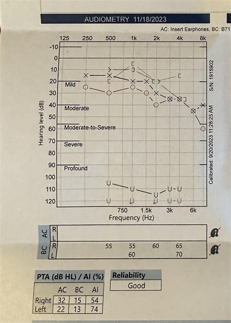Can Someone Decode This Chart For Me Wondering If Hearing Aids Would Be Beneficial R Hearingloss