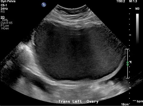 Large Left Ovarian Cystic Structure With Homogeneous Low Level Internal Download Scientific