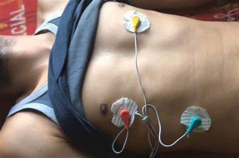 IoT ECG Monitoring With AD ECG Sensor ESP