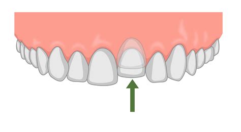 Dental Trauma Geeky Medics