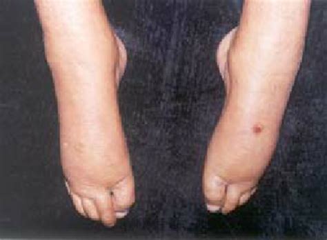 Flexion Deformity Of Lower Limbs Download Scientific Diagram