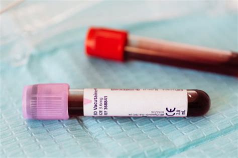 Aspects Of Preanalytical Errors That Influence Laboratory Outcomes