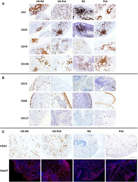 Immunostaining Of Cellular Infiltrate In Synovial Membrane Of Ua Ra
