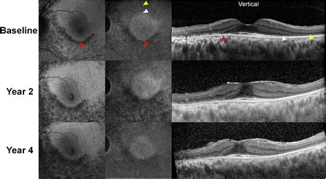 Frontiers Novel Imaging Techniques For Hydroxychloroquine Retinopathy