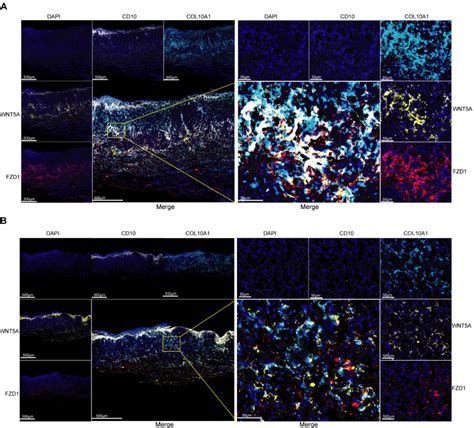 Figure 6 From Single Cell And Spatial Transcriptomic Profiling Revealed