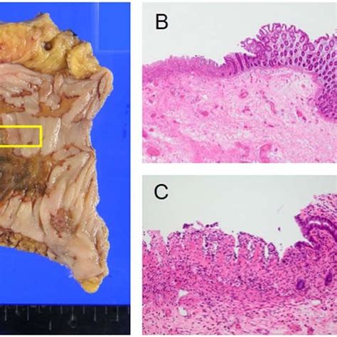 A Gross Appearance Of The Resected Specimen Revealed An Entire Download Scientific Diagram