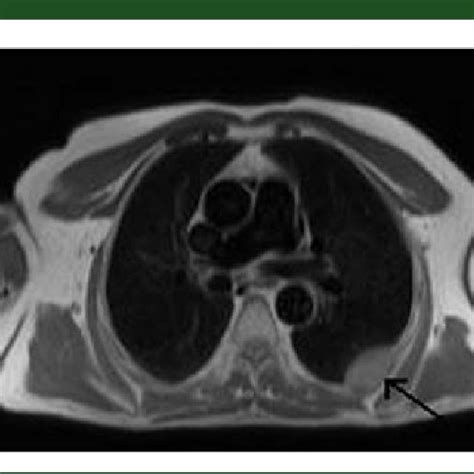 Mri Showing Image Revealing Left Posterior Chest Wall Lesion Download Scientific Diagram