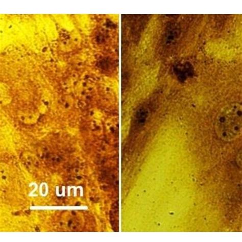 Ag Nucleolar Organizer Regions Agnors Dots Brownish Intra Nuclear