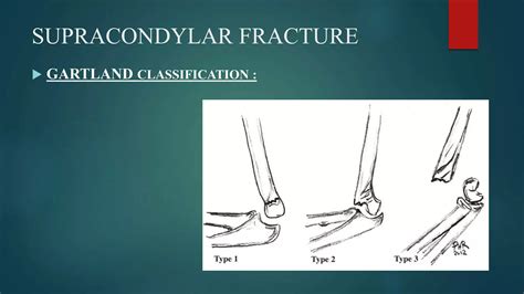Supracondylar Fracture Of Humerus Pptx