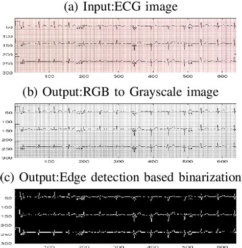 Figure 2 From A Unified Ecg Paper Digitization Framework With R Peak Detection For Rr Interval