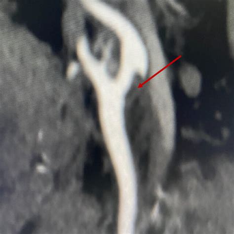 Sagittal Reconstruction Of The Left Common And Internal Carotid