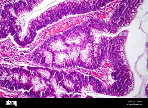 Photomicrograph Of Colon Adenocarcinoma Illustrating Malignant Glandular Cells Characteristic