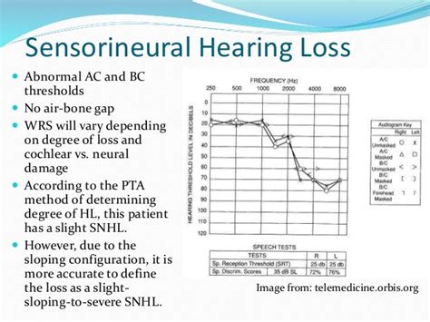 Audiogram Interpretation