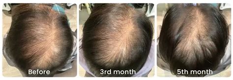 Hair And Scalp Specialist In Singapore Tricholab