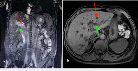 A 70 Years Old Patient With Cholangitis Mri With Coronal T2 A And A 70 Years Old Patient With Cholangitis Mri With Coronal T2 A And