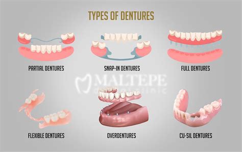 Different Denture Types At Johnnie Allison Blog
