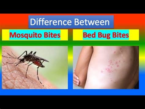 Mosquito Bites Vs Bed Bug Bites Bed Bug Bites Vs Mosquito Bites