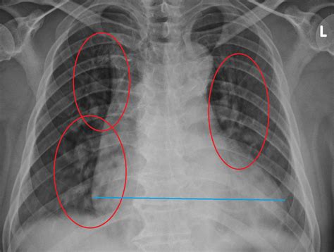 불안 초조를 주소를 지속적으로 호소한 빠른 심방세동 폐부종 심부전