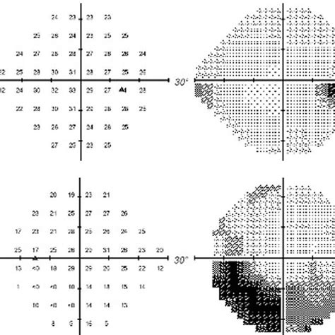 Humphrey Visual Field Test On June 2 A Right Eye No Abnormal Download Scientific Diagram