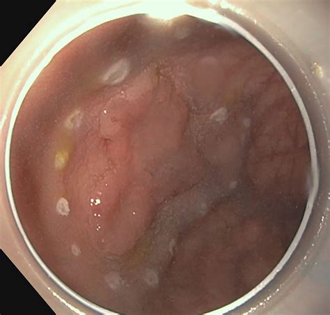 Streptococcus Equinus Bovis Group Sepsis With Endocarditis In A