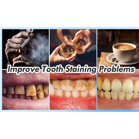 Машина за избелване и полиране на зъби，shijooe® премахване на зъбен камък преносима 5