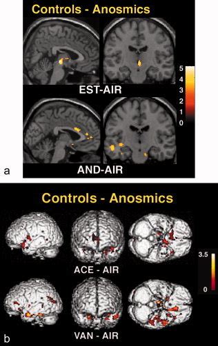 Pheromone Signal Transduction In Humans What Can Be Learned From Olfactory Loss Single