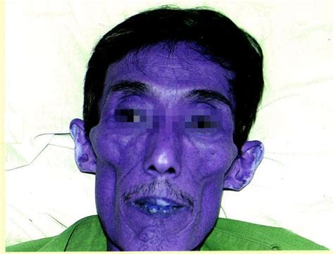 图66 面削颧耸 中医望诊图谱