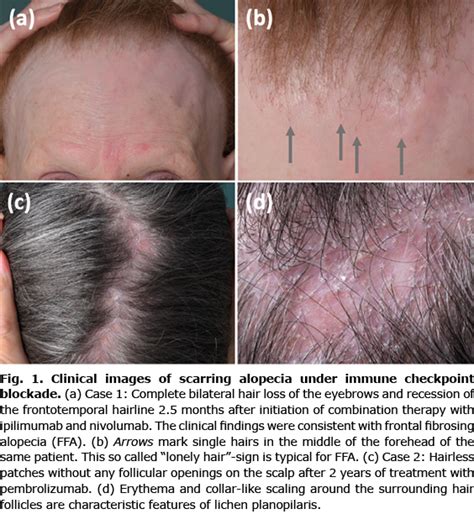 Follicular Hyperkeratosis Scalp