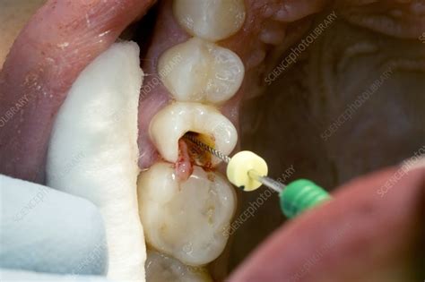 Root Canal Dental Surgery Stock Image C0290466 Science Photo Library
