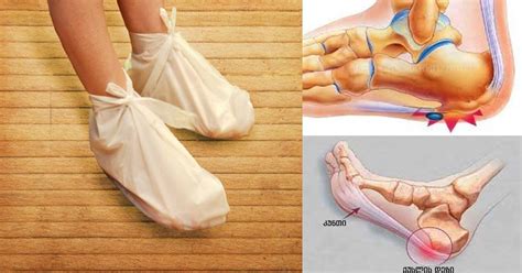 ქუსლის ძვლის დეზის მკურნალობის გამოცდილი ხალხური მეთოდები სასარგებლო რჩევები