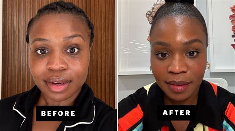 Masseter Botox What To Know About The Off Label Treatment Thats All