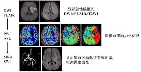 【学术报告整理】急性缺血性卒中影像学评估新策略——陆军军医大学第二附属医院杨清武教授分享 脑医汇