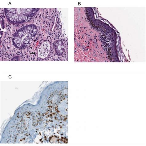 A Grade Iii Gvhd Of Gut Md30 Showing Apoptotic Crypt Cells Thin