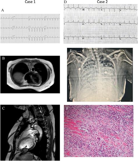 A 54 Year Old Female Electrocardiogram With Diffuse St Segment Download Scientific Diagram