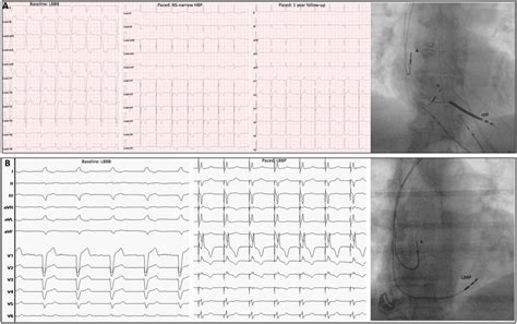Cardiac Resynchronization Therapy Ecg