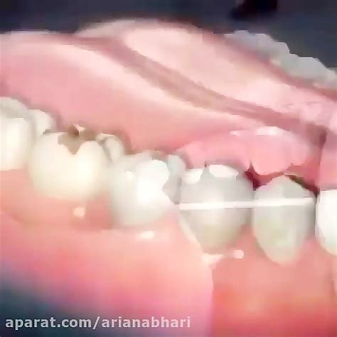 فناوری نوین در کرم خوردگی دندان