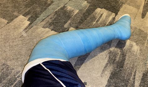 Braces And Casts