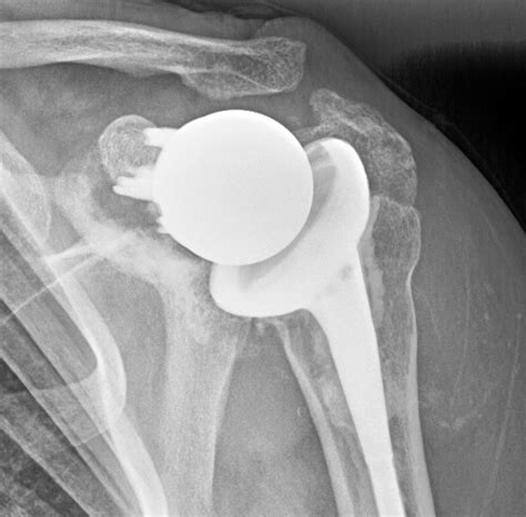Uw Shoulder And Elbow Academy Reverse Total Shoulder Joint Replacement Results And Complications