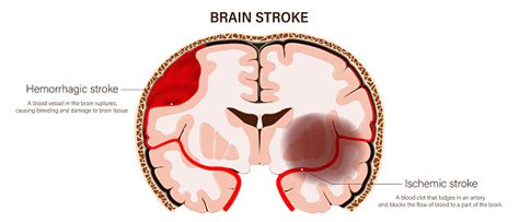Brain Stroke Vector Hemorrhagic Stroke And Ischemic Stroke Brain Tissue