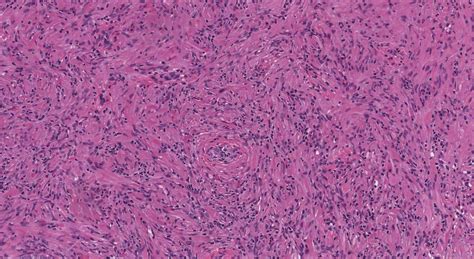 Benign Prostatic Hyperplasia Ottawa Atlas Of Pathology