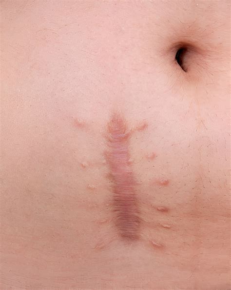 Mengenal Penyakit Keloid Gejala Penyebab Dan Cara Mengobatinya Medisinfo2u