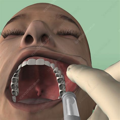 Posterior Superior Alveolar Nerve Block Stock Image C016 6824 Science Photo Library